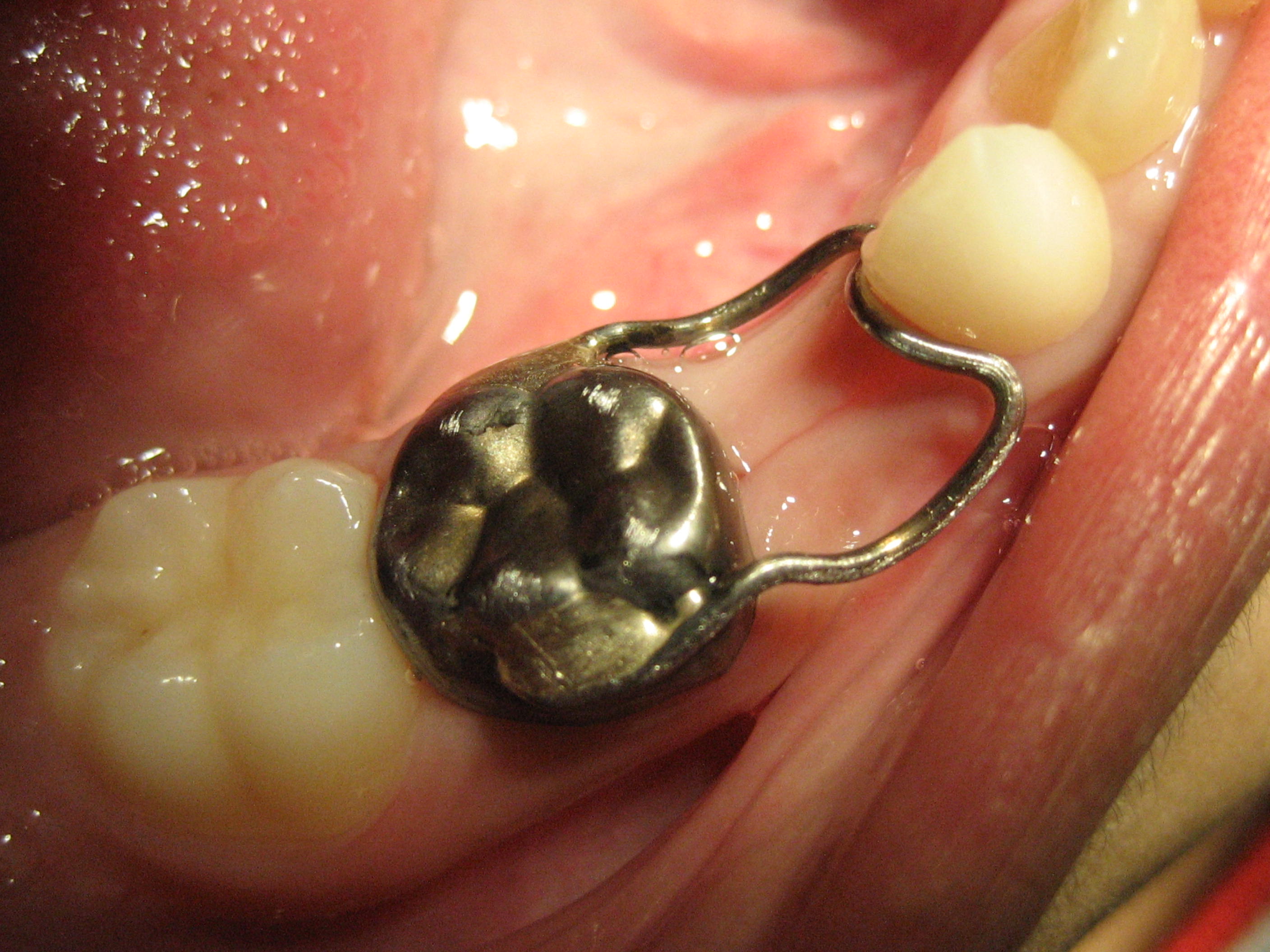 Tooth Spacer Child at Porter Loyd blog